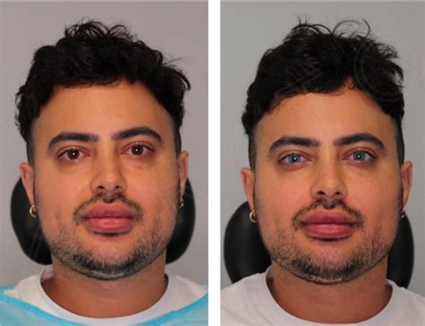 V Deo Cl Nica Est Tica Viraliza V Deo Sobre Procedimento Para