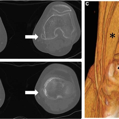 Preoperative Computed Tomography CT Images Preoperative CT Images