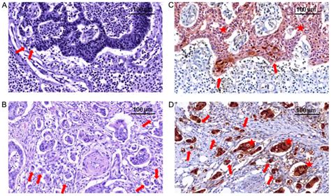 Immunohistochemicalbased Molecular Subtyping Of Colorectal Carcinoma