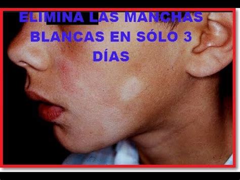 Como Eliminar Manchas Blancas En La Cara De Forma Nat Vrogue Co