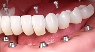 Prótesis sobre implantes Tipos y Ventajas Solución Dental Lima Perú