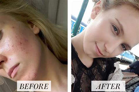 Woman Shares Before And After Photos To Show How Isotretinoin