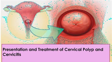 SOLUTION Presentation And Treatment Of Cervictis And Cervical Polyp