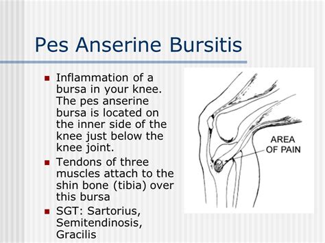 Burning Vulva Treatment Pes Anserine Bursitis Treatment Exercises
