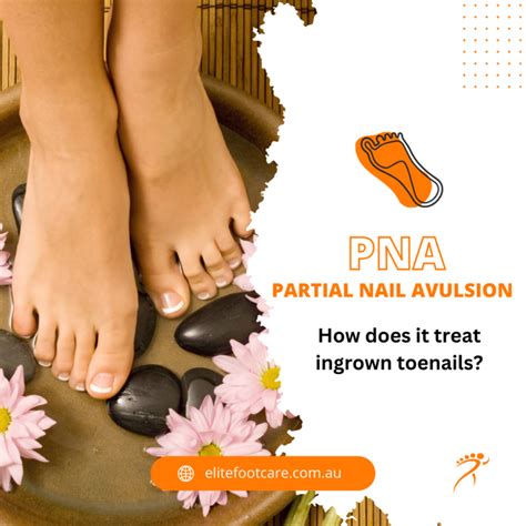 Understanding Ingrown Toenails And The Partial Nail Avulsion Pna