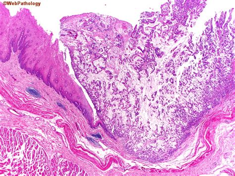 Webpathology A Collection Of Surgical Pathology Images