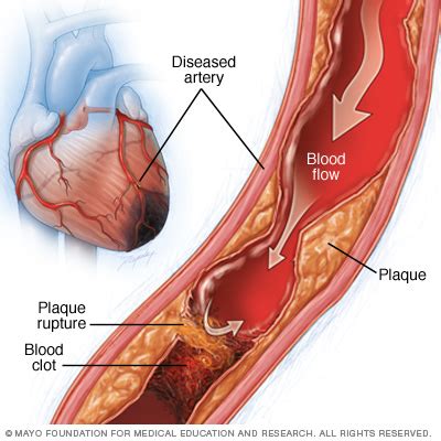 Myocardial Ischemia Disease Reference Guide Drugs