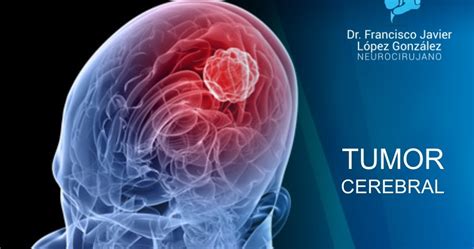 Medico Neurocirujano Dr Francisco J Lopez Gonzalez Síntomas Del Tumor Cerebral Y Tratamiento