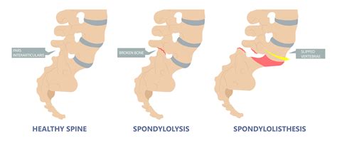 Spondylosis Types
