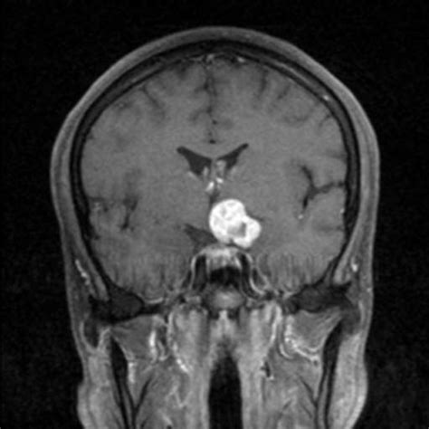 Craniopharyngioma MRI Wikidoc