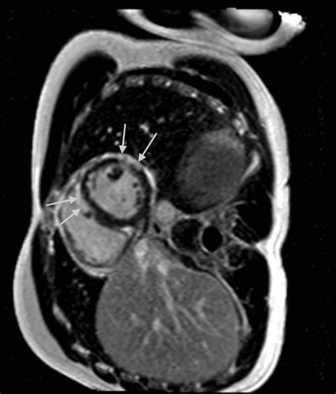 COVID 19 Vaccine Induced Acute Perimyocarditis A Case Report Cureus