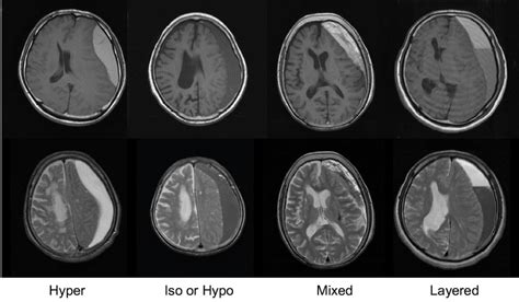 Acute Subdural Hematoma Mri