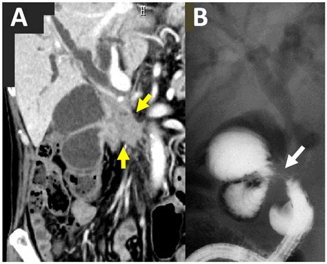 Throughthescope Enteral Metal Stent Placement Using A Shorttype