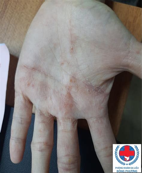 Tay nổi mụn nước là bệnh gì về Phòng khám da liễu Đông Phương riviu vn