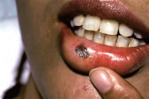 Lesiones pigmentadas en la cavidad oral Dento Metric Radiología