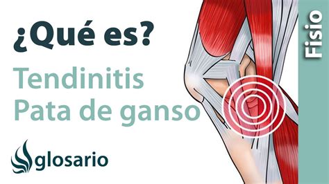 TENDINITIS DE LA PATA DE GANSO Qué es YouTube