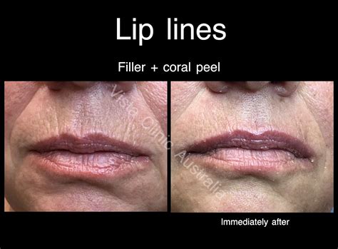 LIPS CONCERNS Vista Clinic Melbourne