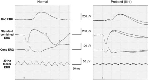full field electroretinograms of a subject with normal vision and the download scientific