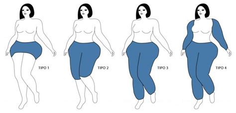 Lipedema Qu Es C Mo Evoluciona Y Tipos De Tratamientos En Pozuelo