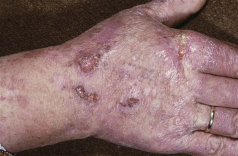 Epidermodysplasia Verruciformis Clinical Gate