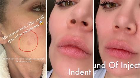 Khloé Kardashian mostra antes e depois de remoção de câncer de pele no