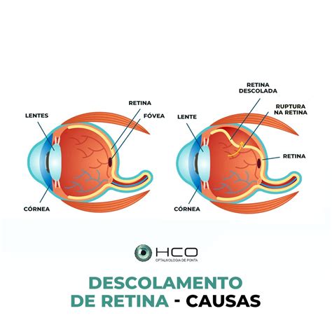 O Que O Descolamento De Retina Sa De Vitalidade