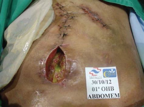 Enterocutaneous Fistula With Active Draining At The Beginning Of