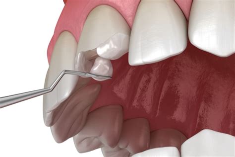 Chipped Tooth Repair Molar