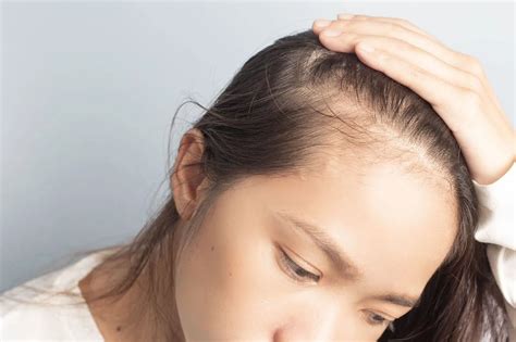 Rụng tóc nhiều ở nữ Nguyên nhân triệu chứng và cách điều trị