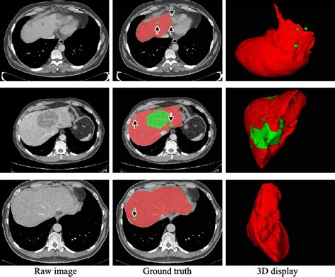 [pdf] h denseunet hybrid densely connected unet for liver and tumor segmentation from ct