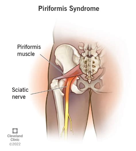 Best Back Braces For Sciatica And Piriformis Syndrome OrthoMed Canada