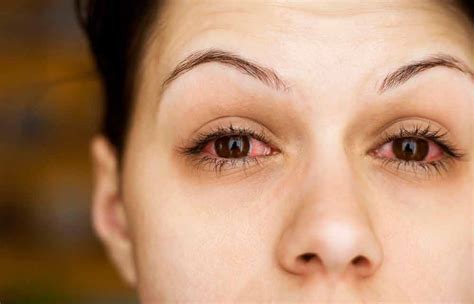 Conjuntivitis Papilar qué es causas y tratamiento Área Oftalmológica