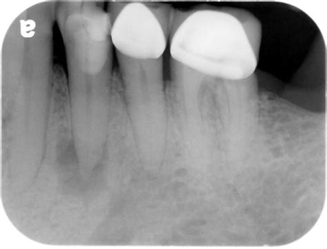 Rarefying Osteitis Premolar Periapical Dr G S Toothpix