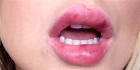 Painful Swollen Lips After Filler Lipstutorial Org