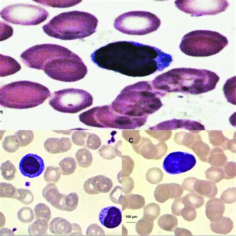A Trilobulate Atypical Lymphocyte Image Obtained Through Microscopic