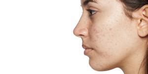 Cómo eliminar un grano de la cara rápidamente Todos los trucos para