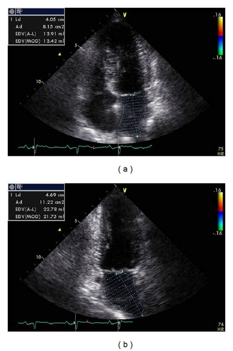 Measurement Of Left Atrial Volume From Biplane Method Of Disks