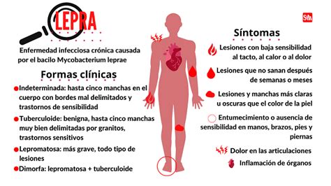 Lepra Tratable Y Curable Infomed Santiago