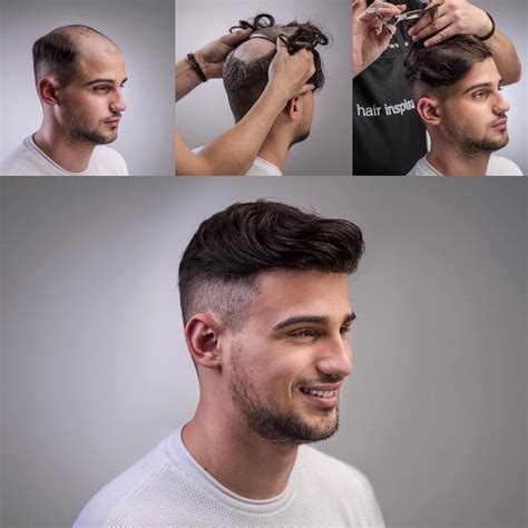 Fitting y aplicación de la prótesis capilar Hair Inspira