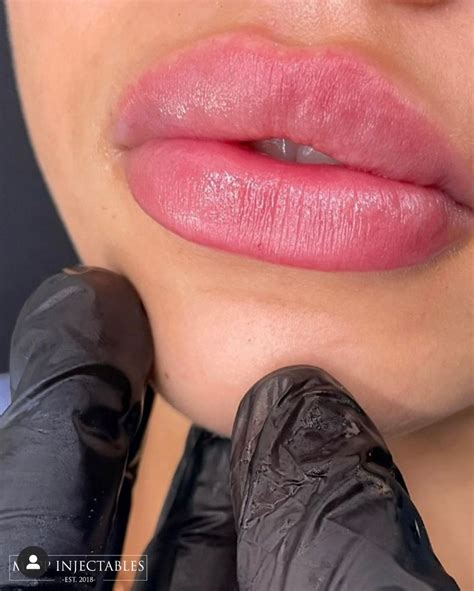 Russian Lip Technique Lip Augmentation Lip Filler Nyc Artofit