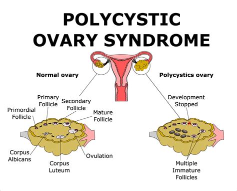 Mengenal Polycystic Ovary Syndrome PCOS Serta Gejala Yang Harus