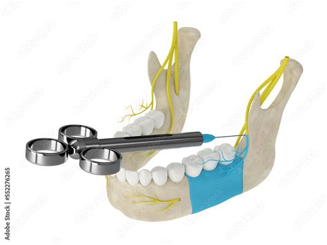 Mandibular Arch With Buccal Nerve Block Illustration Stock Adobe Stock