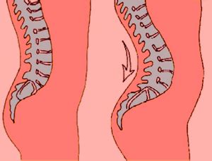 Lumbar Lordosis Fix Symptoms Causes Treatment Pictures