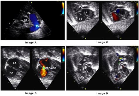 Echocardiography Parasternal Short Axis View In Systemic Duct Dependent