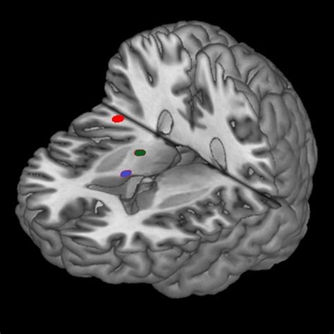 classification of alzheimer s disease stages an approach using pca based algorithm fayyaz