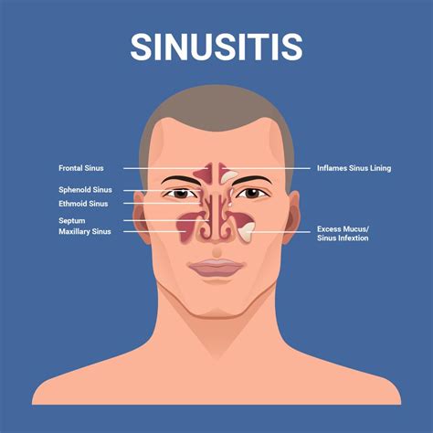 Sinusitis Vector Illustration 170632 Vector Art At Vecteezy