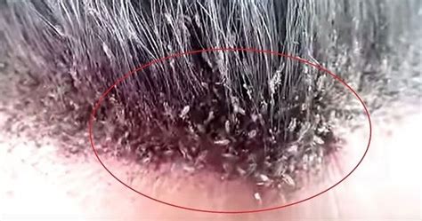PARASITOLOGÍA Diagnóstico diferencial de Pediculus Humanus Capitis