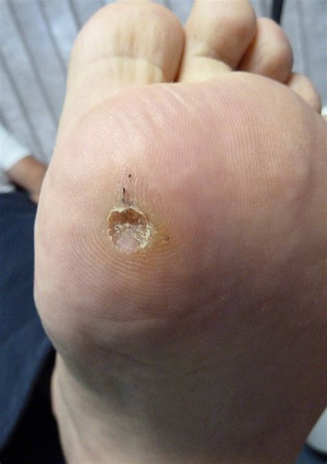Plantar Wart Treatment Instructions At Margaret Clark Blog