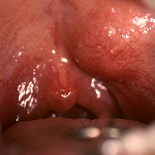 Nodules De La Muqueuse Buccale Dermatologie Buccale Dr Lotfi Benslama
