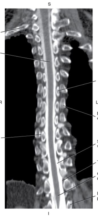 Coronal Ct Reformat Of Thoracic Spine With Intrathecal Contrast